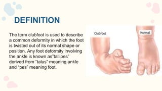 Club foot in Child | PPTX