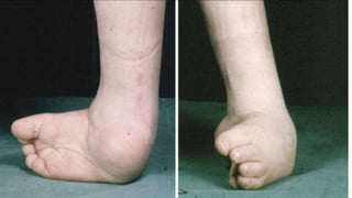 Club foot in Child | PPTX