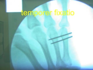 Rare ligamental (DTML) hand injury (oral presentation); 2nd award for ...