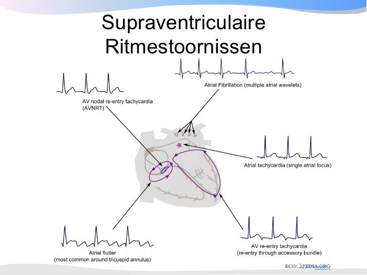 Ritmestoornissen ECGpedia 2008
