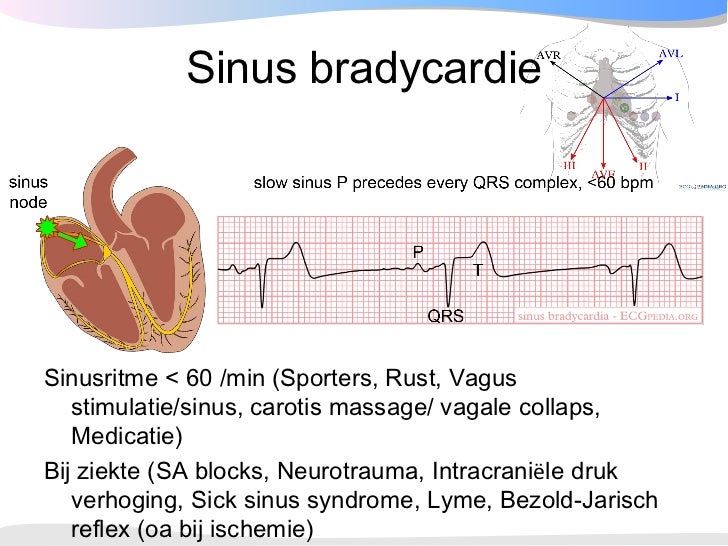Ritmestoornissen ECGpedia 2008
