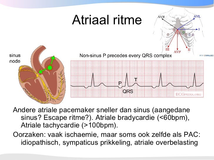 Ritmestoornissen ECGpedia 2008