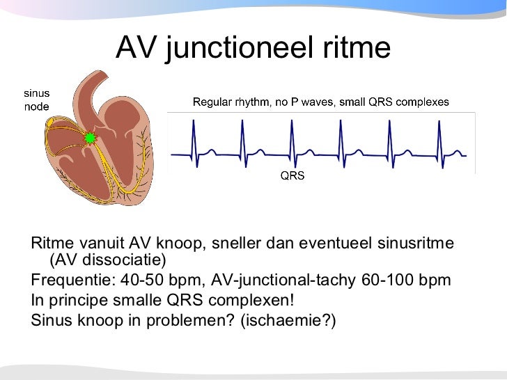Ritmestoornissen ECGpedia 2008