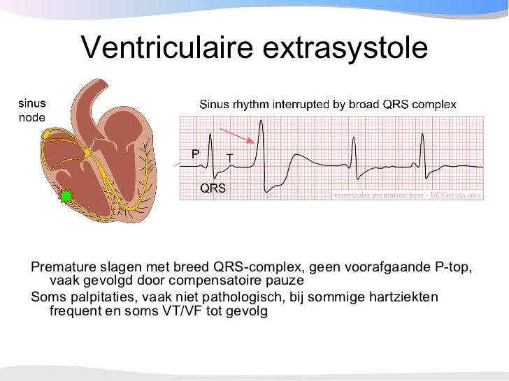 Ritmestoornissen ECGpedia 2008