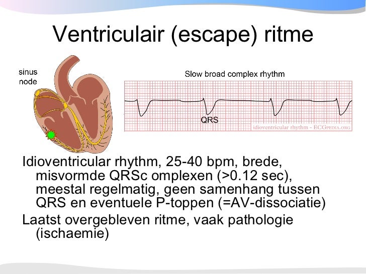 Ritmestoornissen Ecgpedia 2008