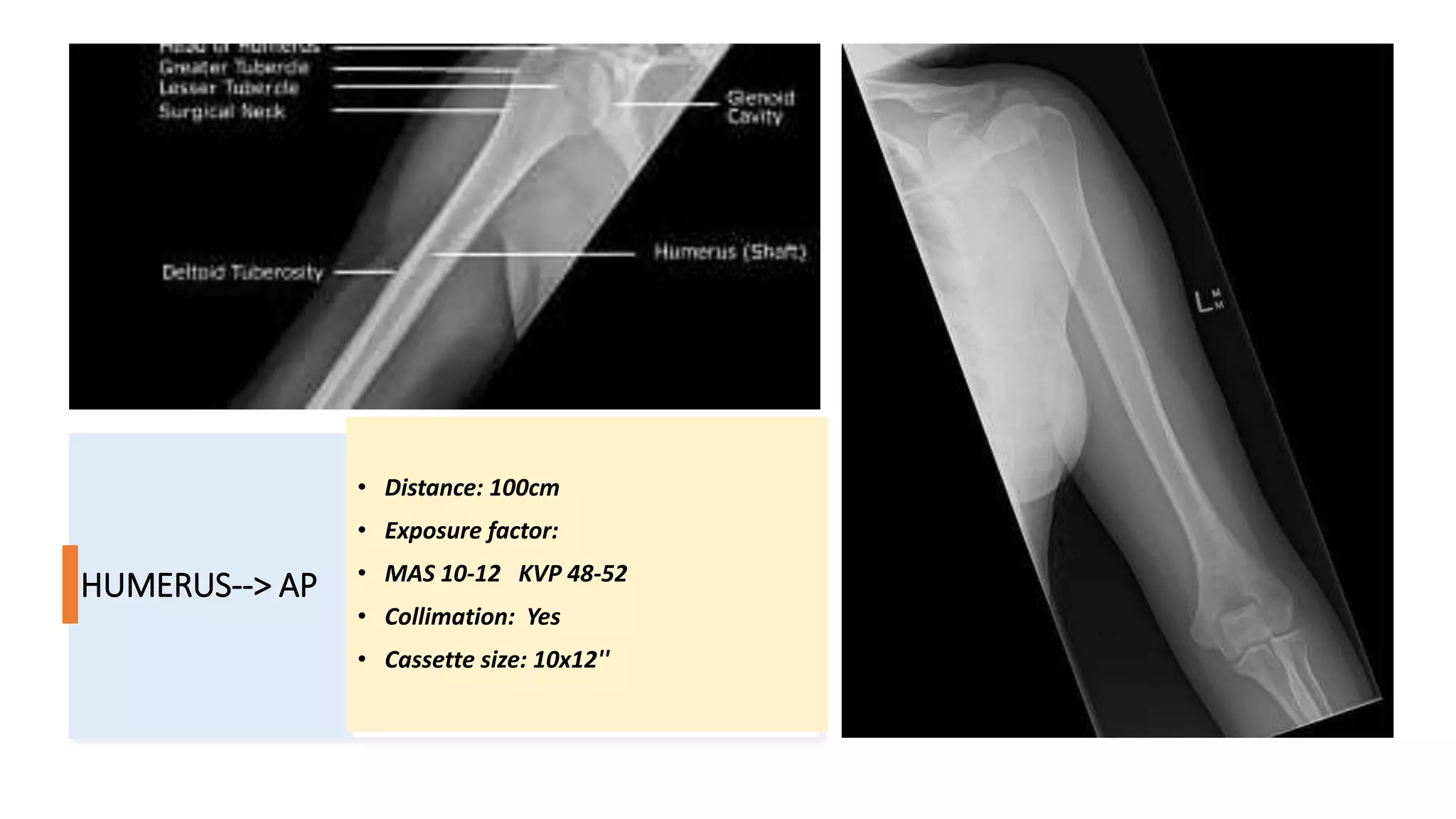 Radiographic positioning of Upper limb (ELBOW & HUMERUS) | PPTX