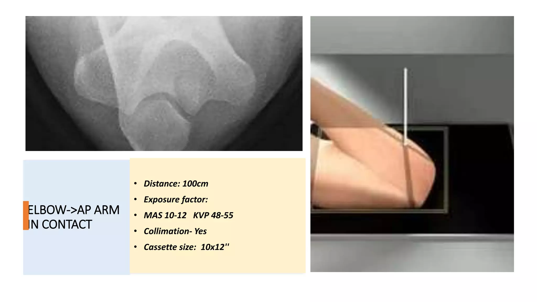Radiographic positioning of Upper limb (ELBOW & HUMERUS) | PPTX