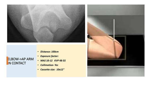 Radiographic positioning of Upper limb (ELBOW & HUMERUS) | PPTX | Death ...