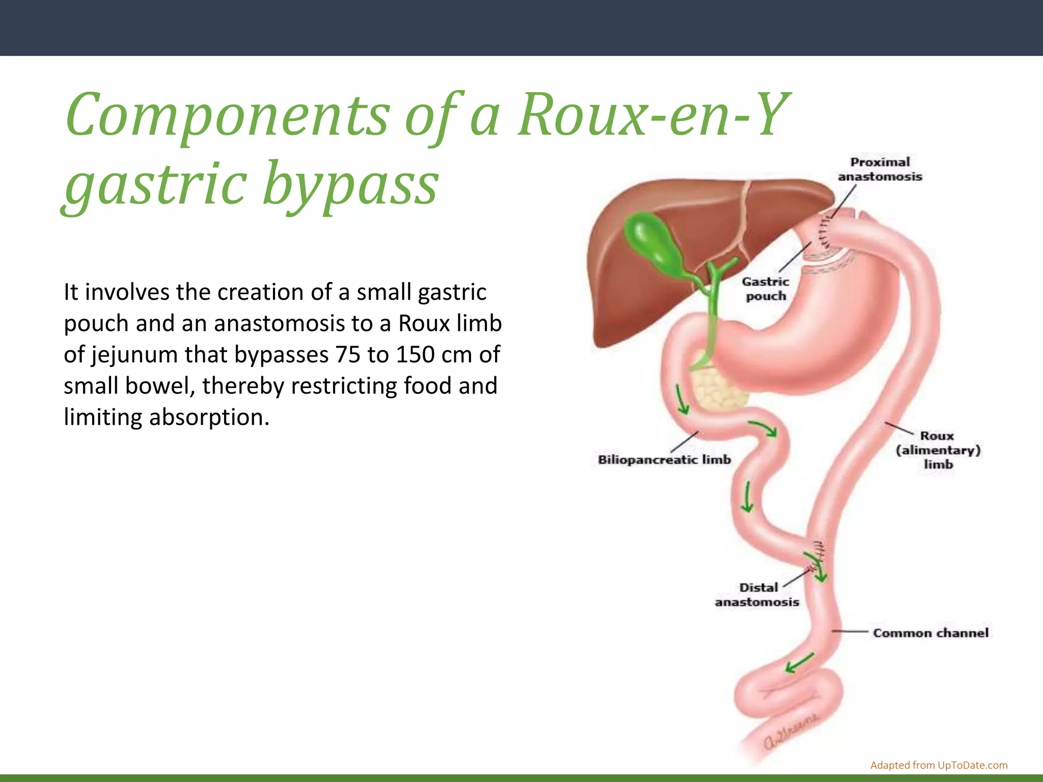 Rivision surgery after laparoscopic sleeve gastrectomy | PPTX
