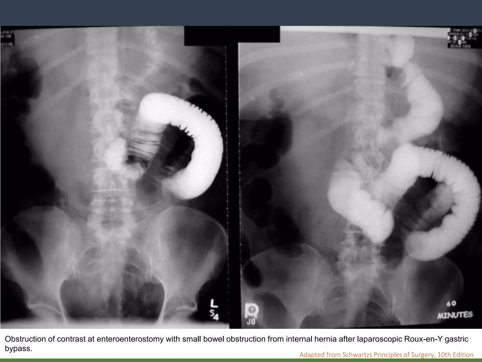 Rivision surgery after laparoscopic sleeve gastrectomy | PPTX