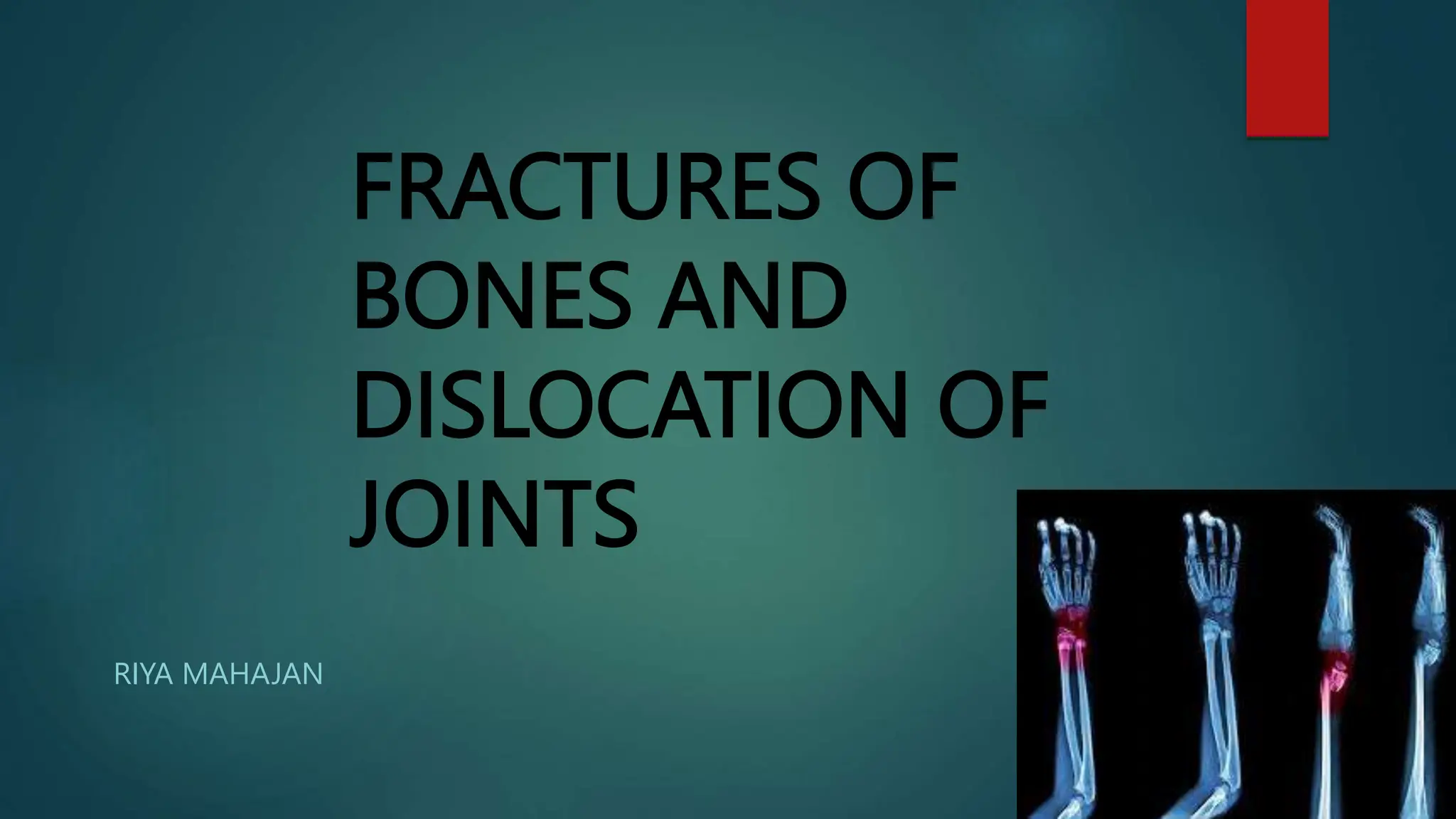 RIYA FRACTURE PPT.pptx
