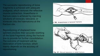 RIYA FRACTURE PPT.pptx