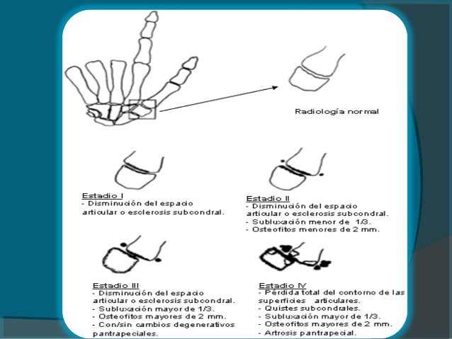 Rizartrosis