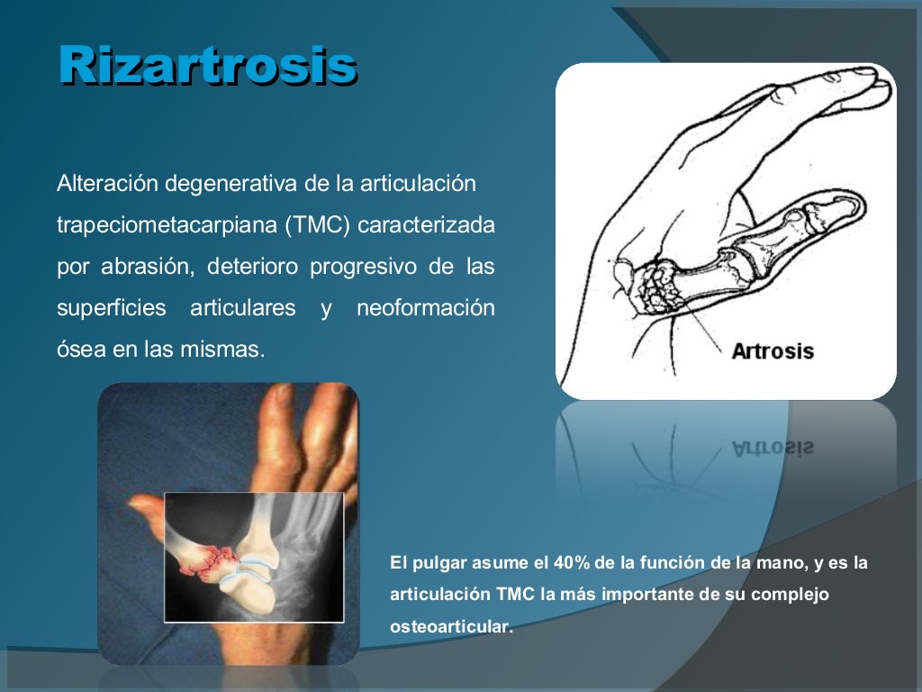 Rizartrosis