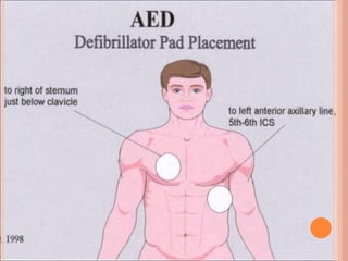Rjp dan defibrilasi ( pertemuan keempat) | PPT
