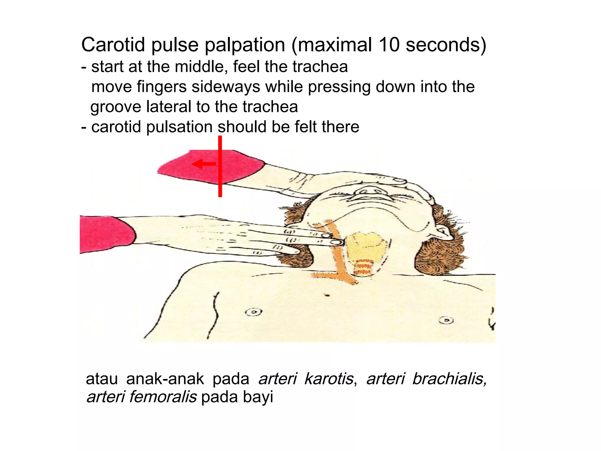 RJPO (Resusitasi Jantung Paru Otak) | PPT