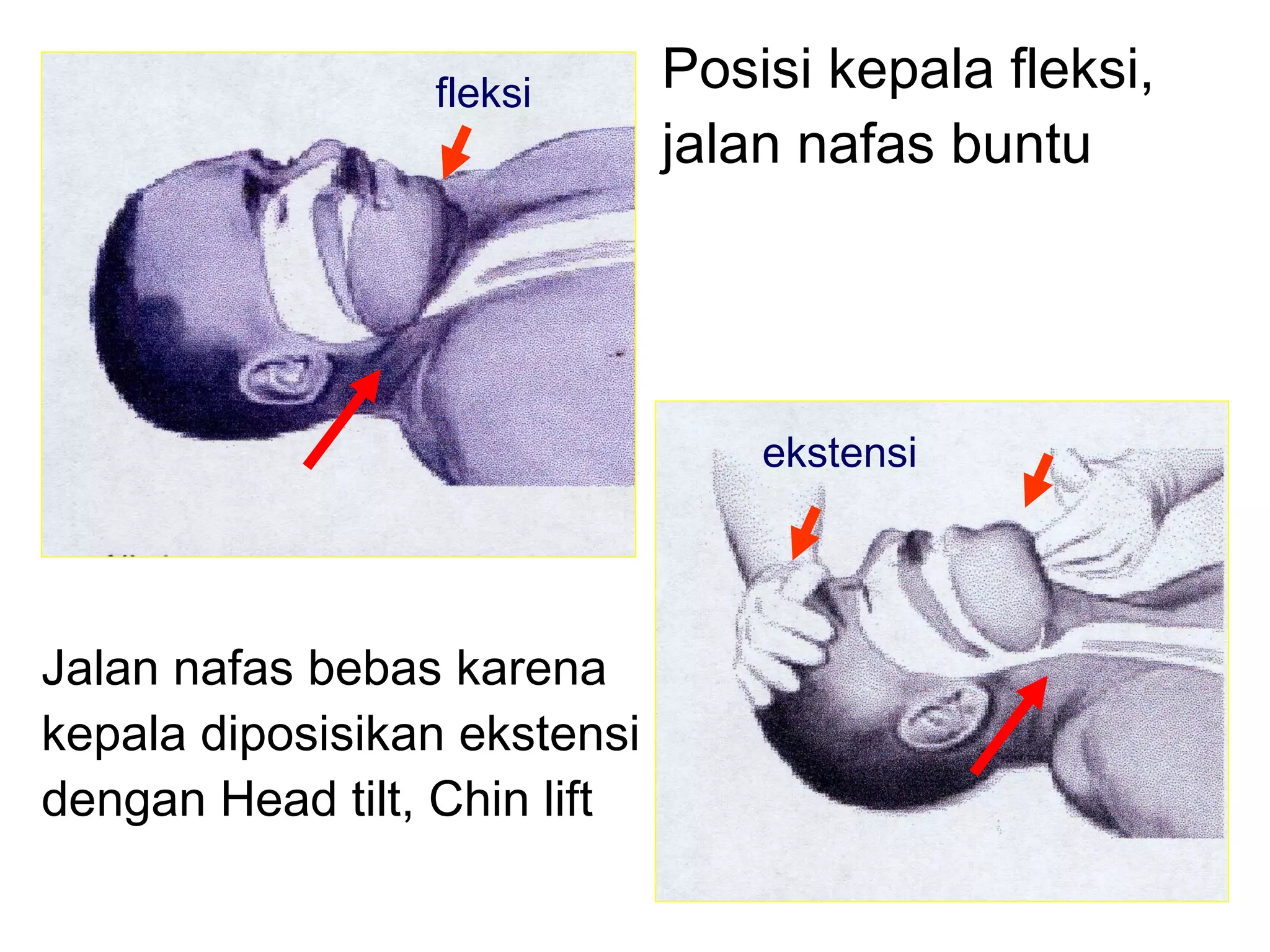 RJPO (Resusitasi Jantung Paru Otak) | PPT
