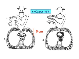 RJPO (Resusitasi Jantung Paru Otak) | PPT