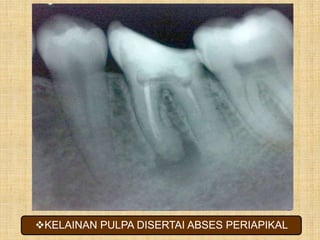 Interpretasi Foto Rontgen: Kelainan Pulpa dan Jaringan Periapikal | PPTX