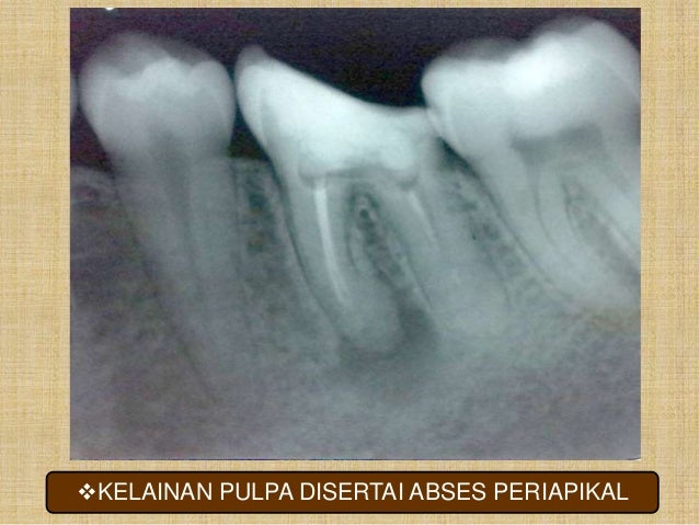 Interpretasi Foto Rontgen: Kelainan Pulpa dan Jaringan Periapikal