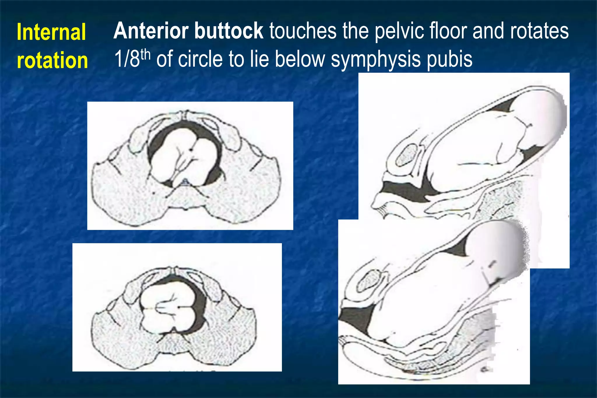 Breech Obstetrics. | PDF