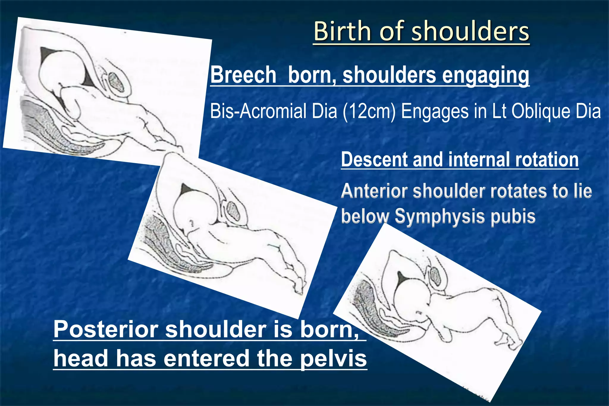 Breech Obstetrics. | PDF