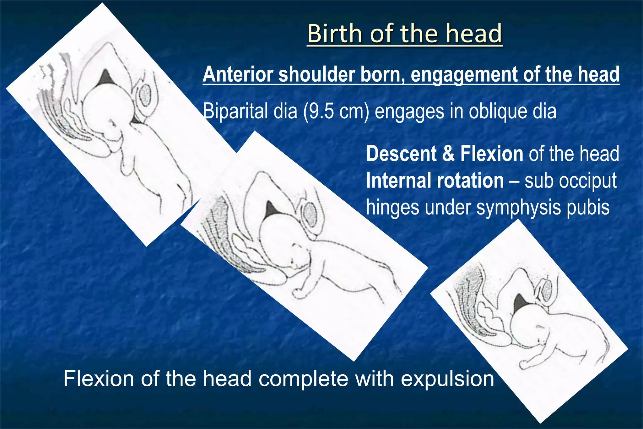 Breech Obstetrics. | PDF