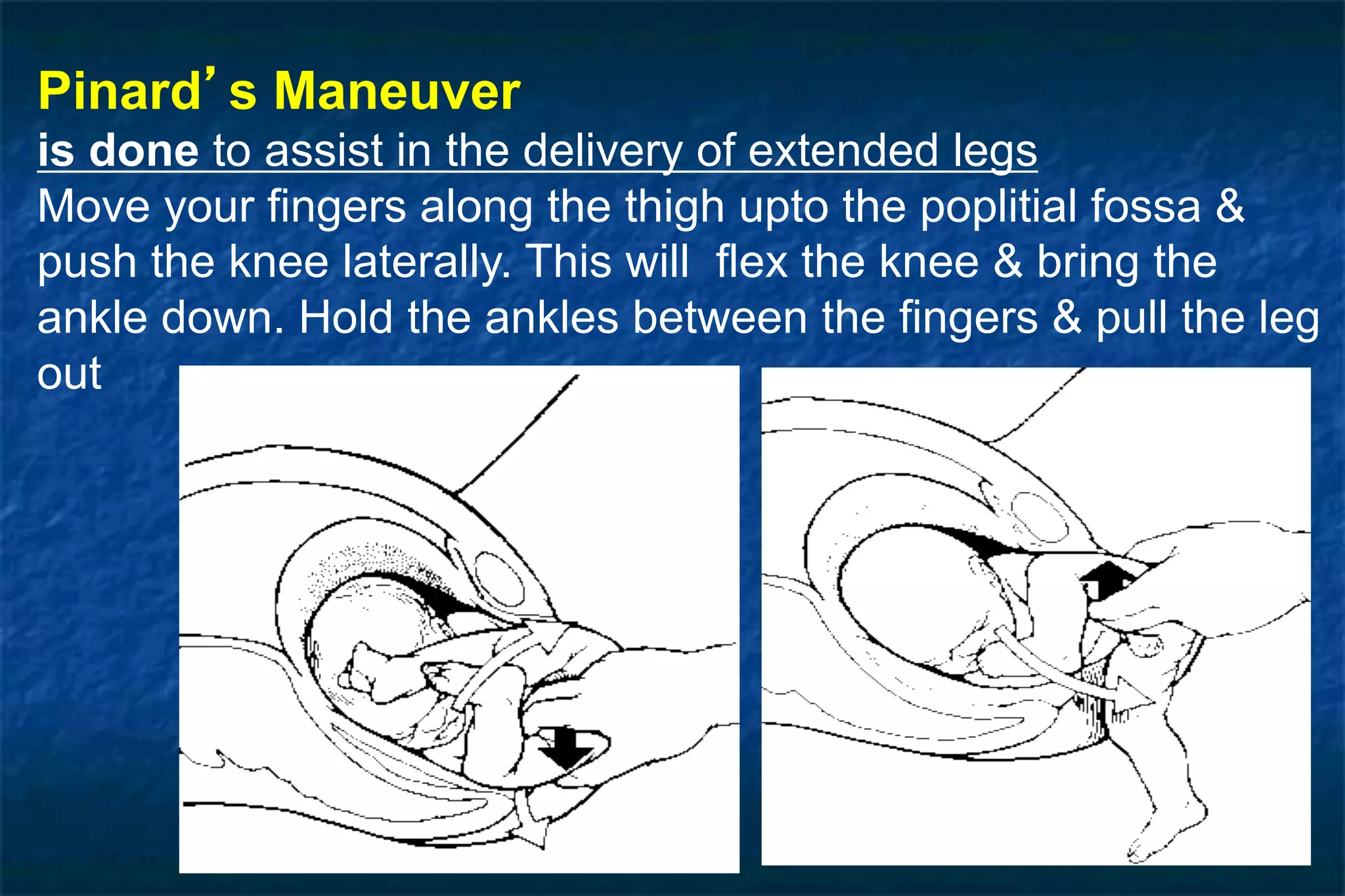 Breech Obstetrics. | PDF