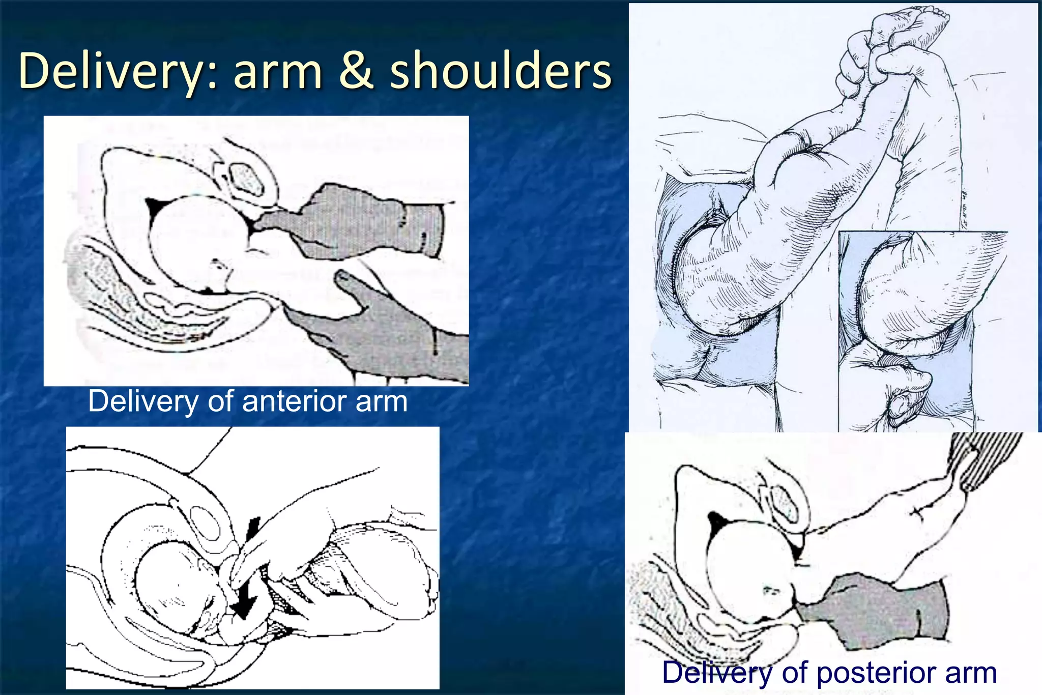 Breech Obstetrics. | PDF
