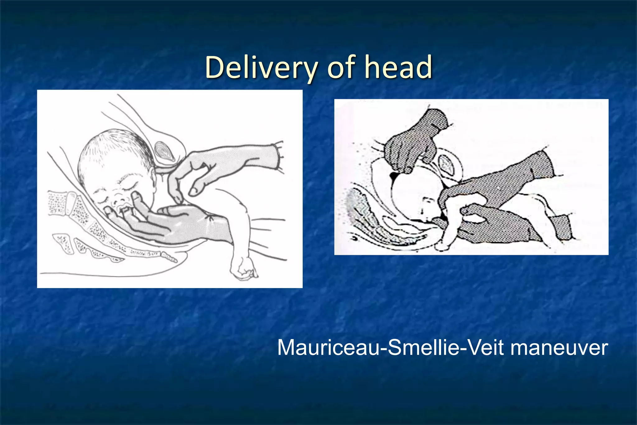 Breech Obstetrics. | PDF