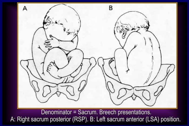 Breech Obstetrics. | PDF
