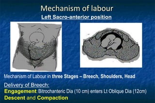 Breech Obstetrics. | PDF