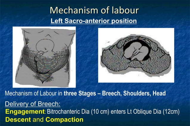 Breech Obstetrics. | PDF