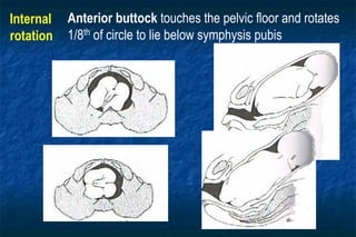 Breech Obstetrics. | PDF