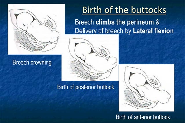 Breech Obstetrics. | PDF