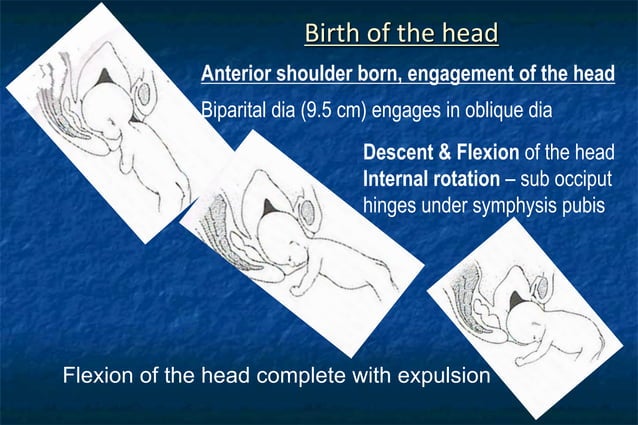 Breech Obstetrics. | PDF