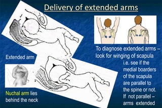 Breech Obstetrics. | PDF