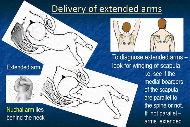 Breech Obstetrics. | PDF