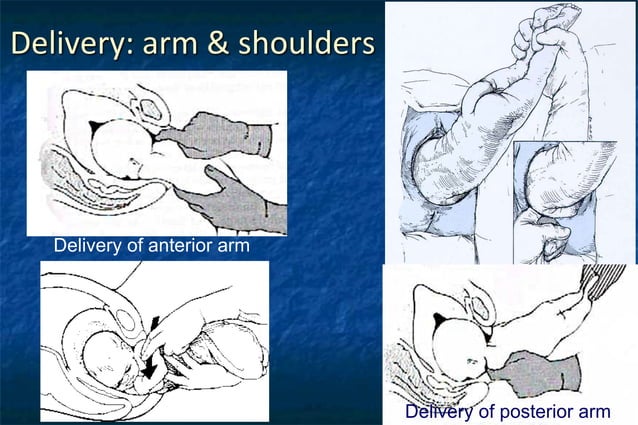 Breech Obstetrics. | PDF