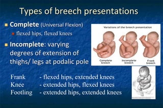 Breech Obstetrics. PPT
