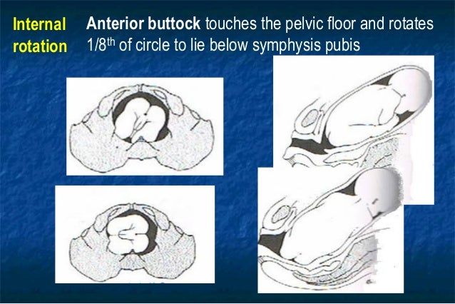 Breech Obstetrics.