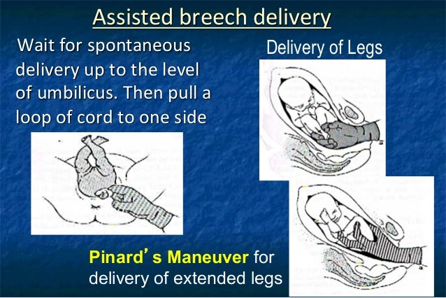Breech Obstetrics.