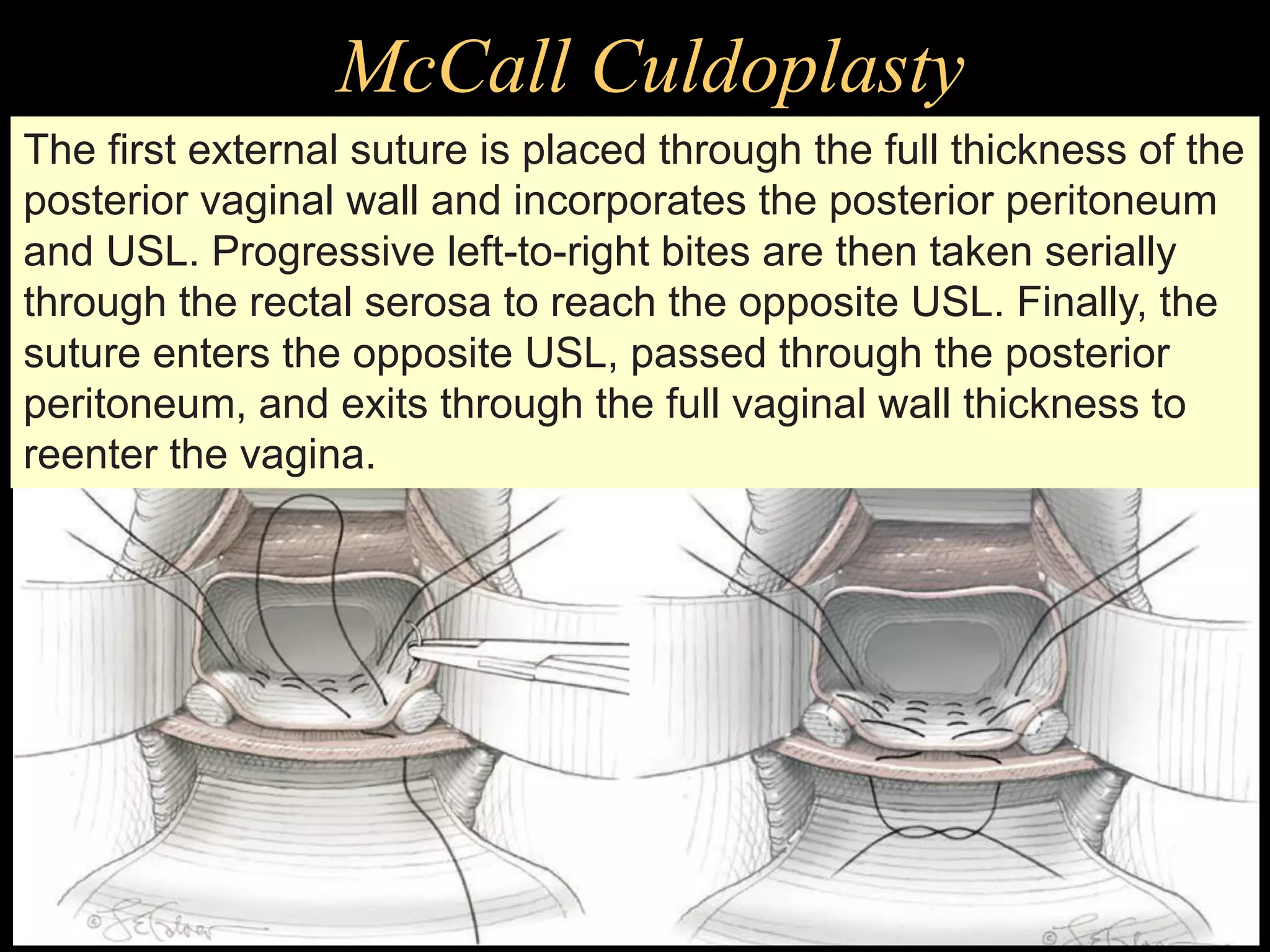 Vaginal Hysterectomy Ppt