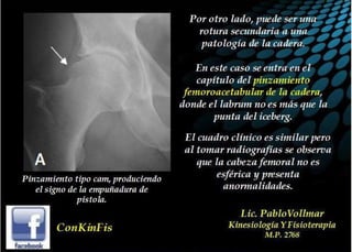 Rotura del Labrum de la Cadera | PDF