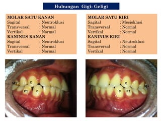 Orthodontics threatment, use of retainer to correct space of central ...
