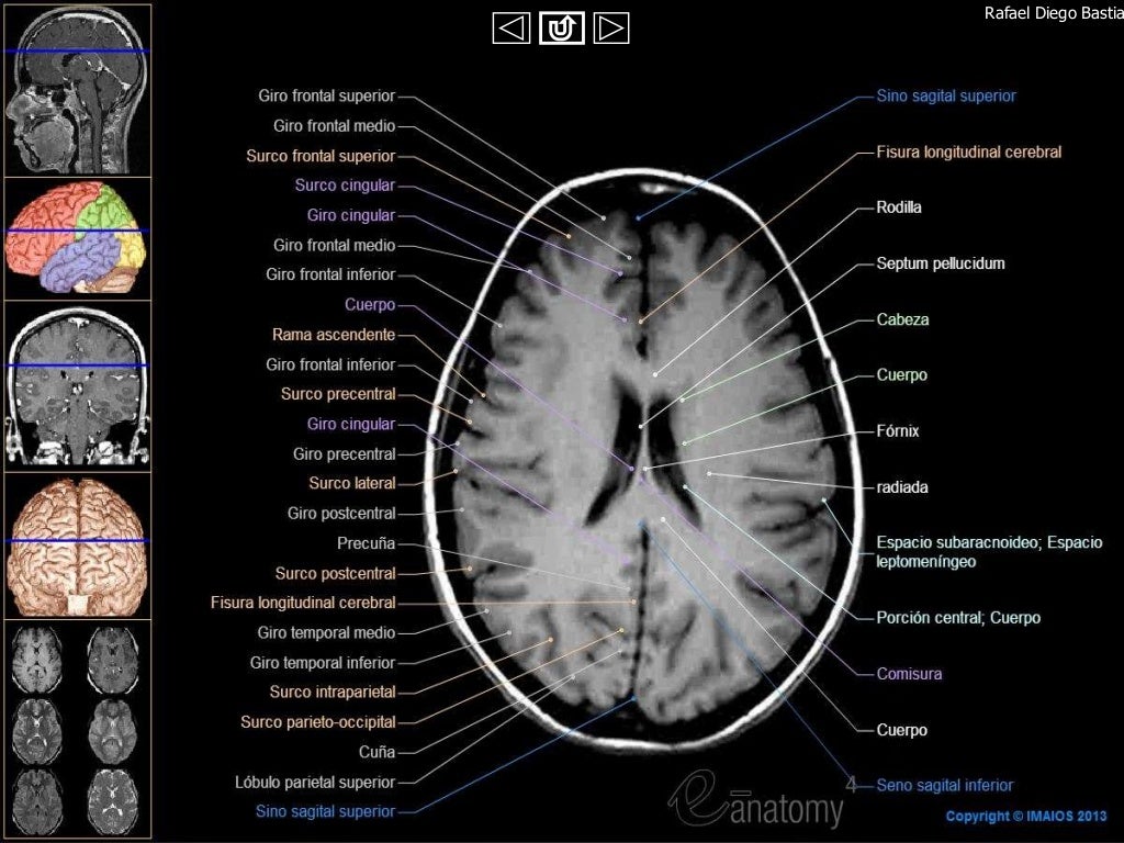 Rm Normal de cráneo