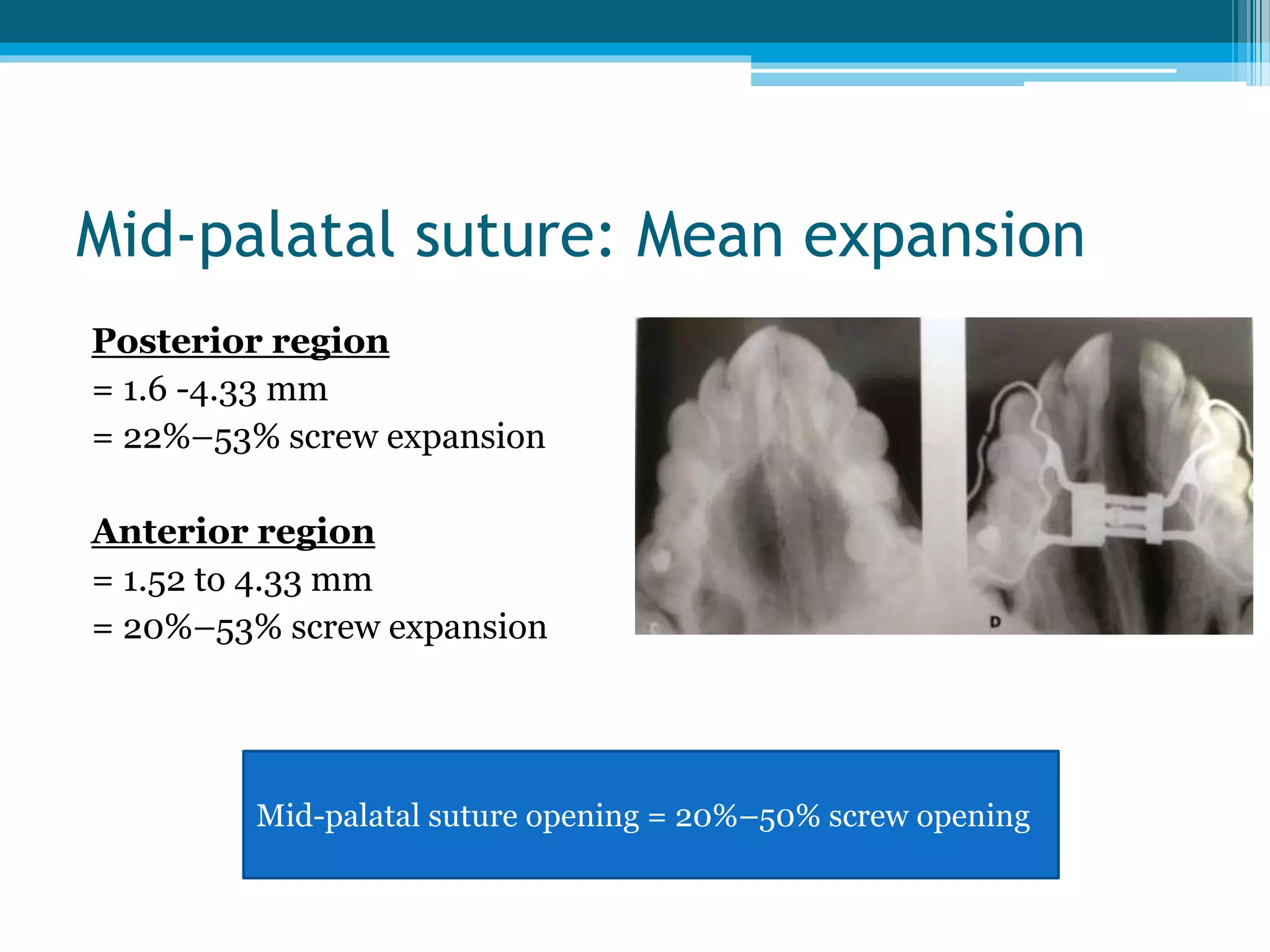Rapid Maxillary Expansion : An Update | PPTX
