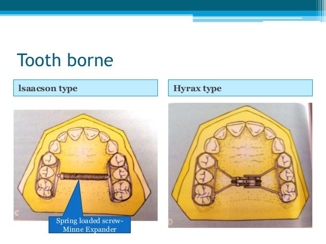 Rapid Maxillary Expansion : An Update
