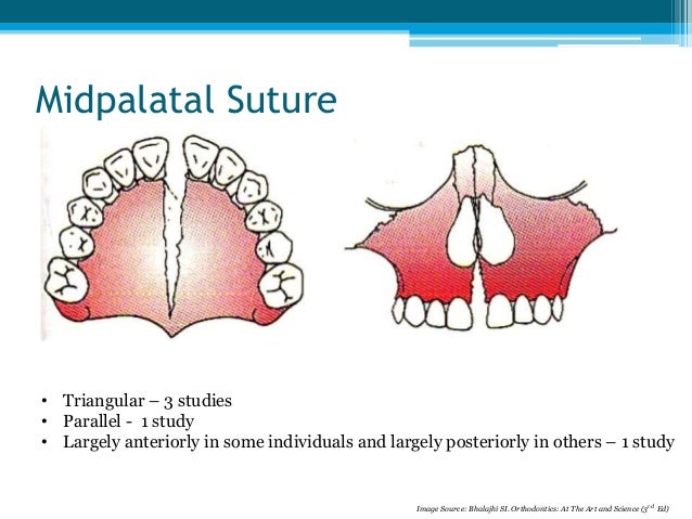 Rapid Maxillary Expansion : An Update
