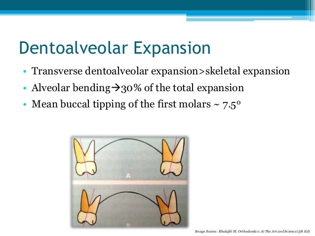 Rapid Maxillary Expansion : An Update
